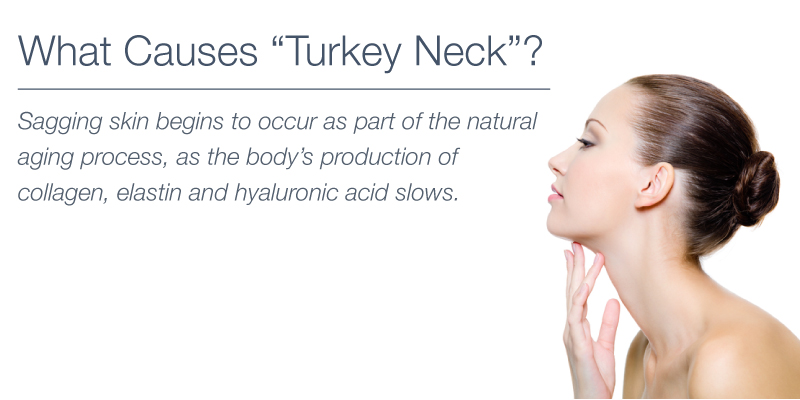 BREAKUP WITH TURKEY NECK – Aloette MS & AR Central